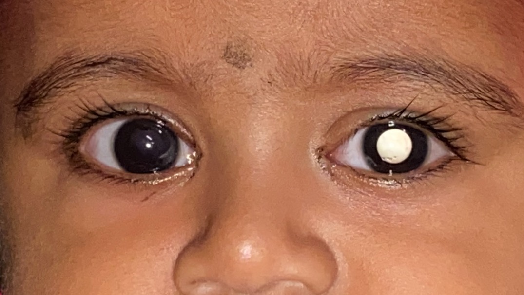 Mission Jeevan: Saving Eyes & Lives – Mission for Vision