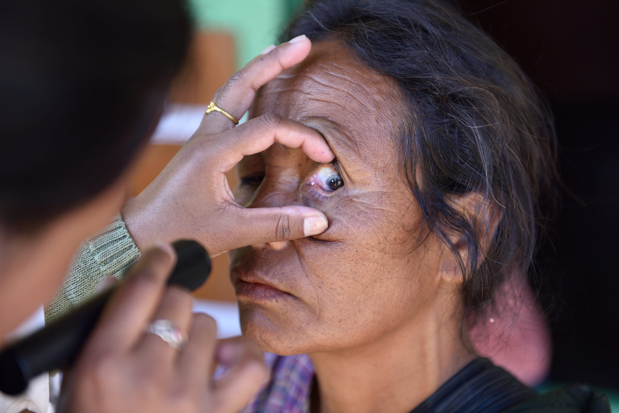 Cataract and Mental Health – Mission for Vision